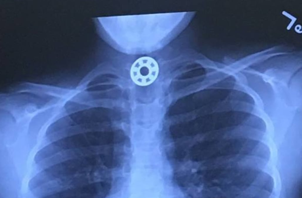 Mom shares warning after daughter nearly chokes to death on 'fidget ...