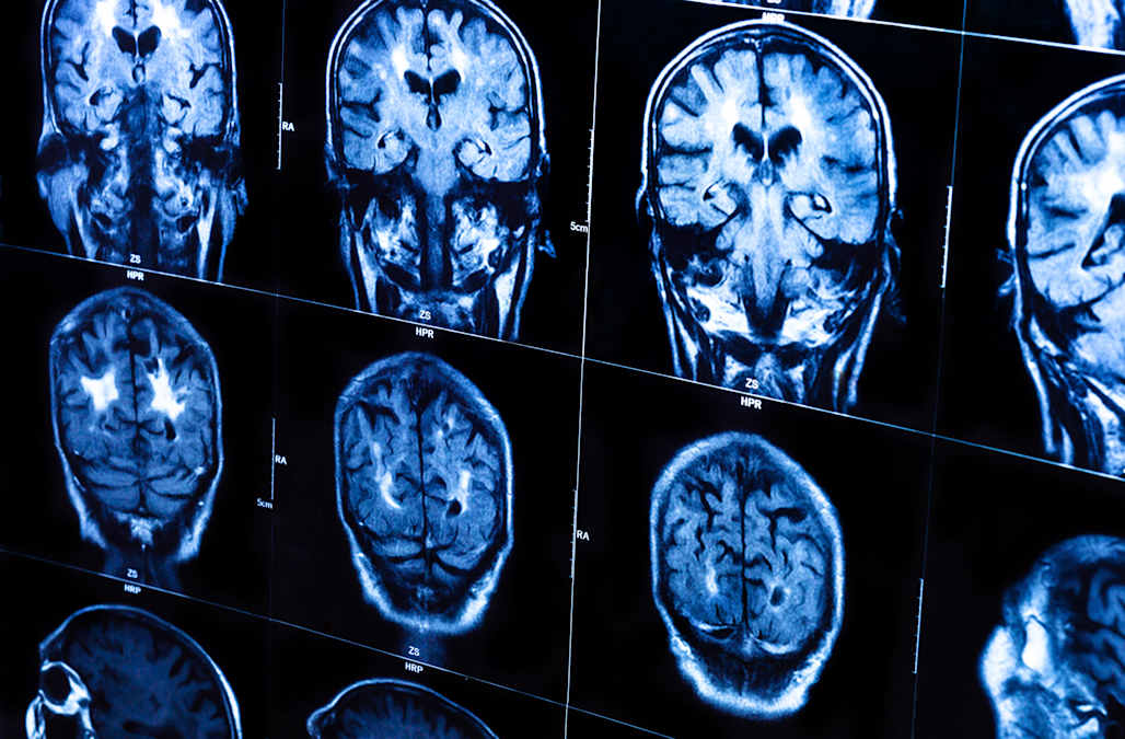 Lasting brain changes seen in college athletes after concussion