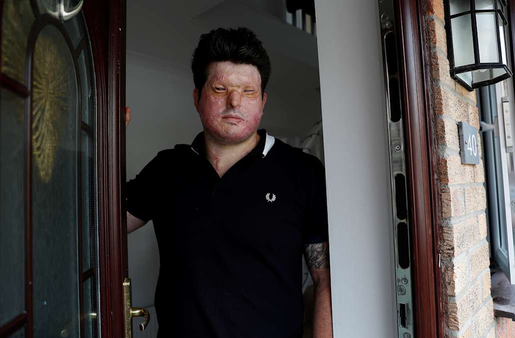 UK acid attack survivors call for tougher sentences - AOL