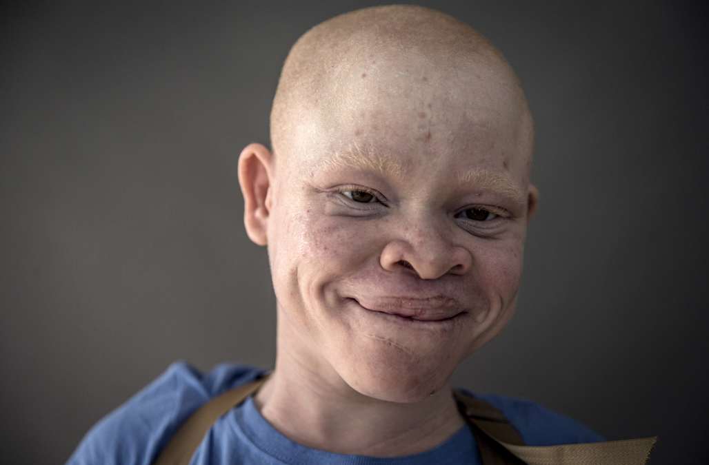 Senegal seeks to protect albinos against their biggest killer -- the ...